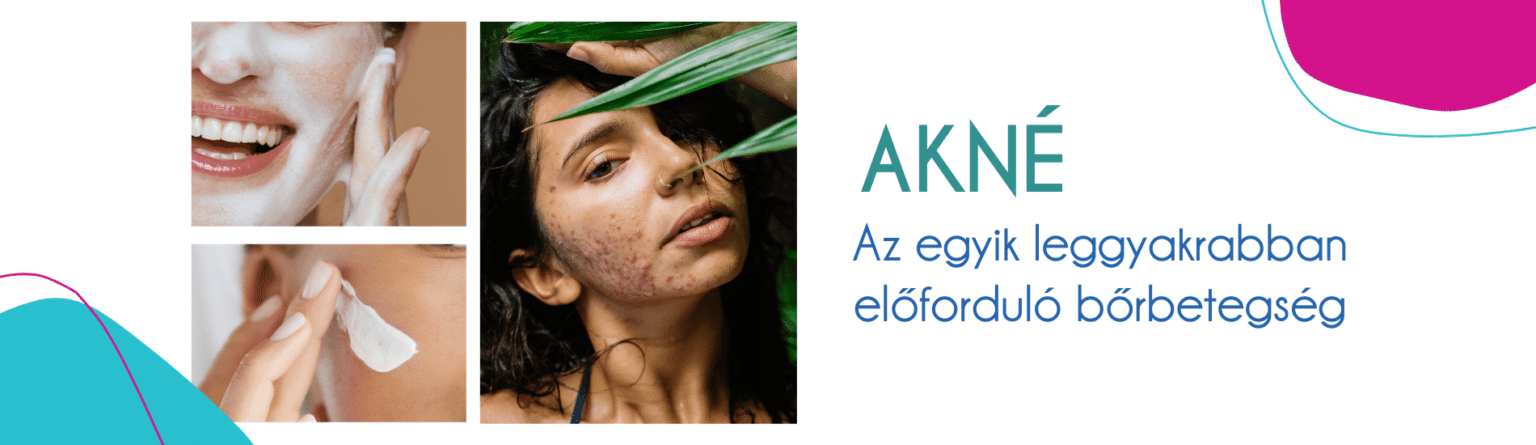 Akné, az egyik leggyakrabban előforduló bőrbetegség - Oxygeni