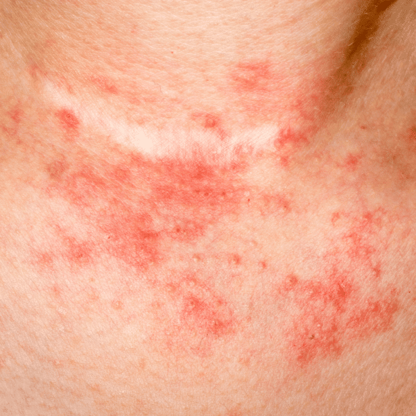 Ekcéma - Oxygeni Hair & Skin - Hajgyógyászati és kozmetikai oxigénterápia