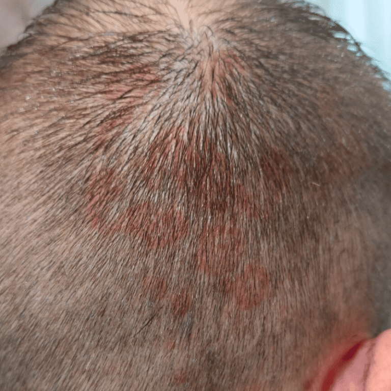 Seborrhea - Oxygeni Hair & Skin - Hajgyógyászati és kozmetikai ...