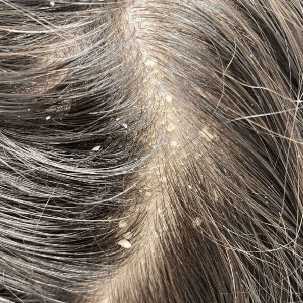 Zsíros korpa - Hogyan ismerjük fel és kezeljük? - Oxygeni Hair