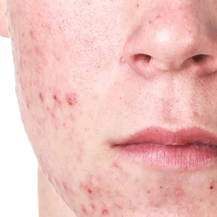 Az akné kialakulása és kezelése